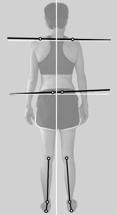 Considerations for Leg Length Discrepancies