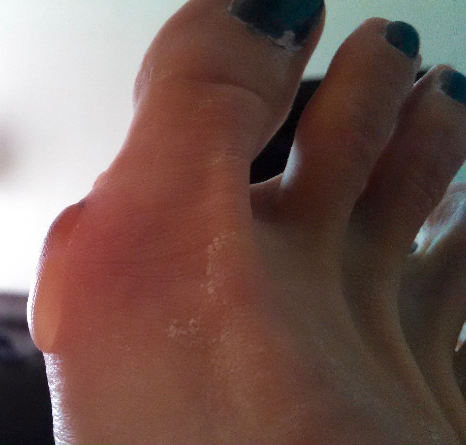 Fix Your Running Blisters with Hip Alignment Exercises: Gadrie’s Story ...